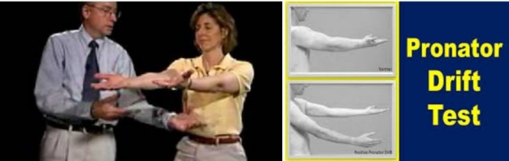 미묘한 편측검사 Pronator Drift (Barre's sign) : 네이버 블로그