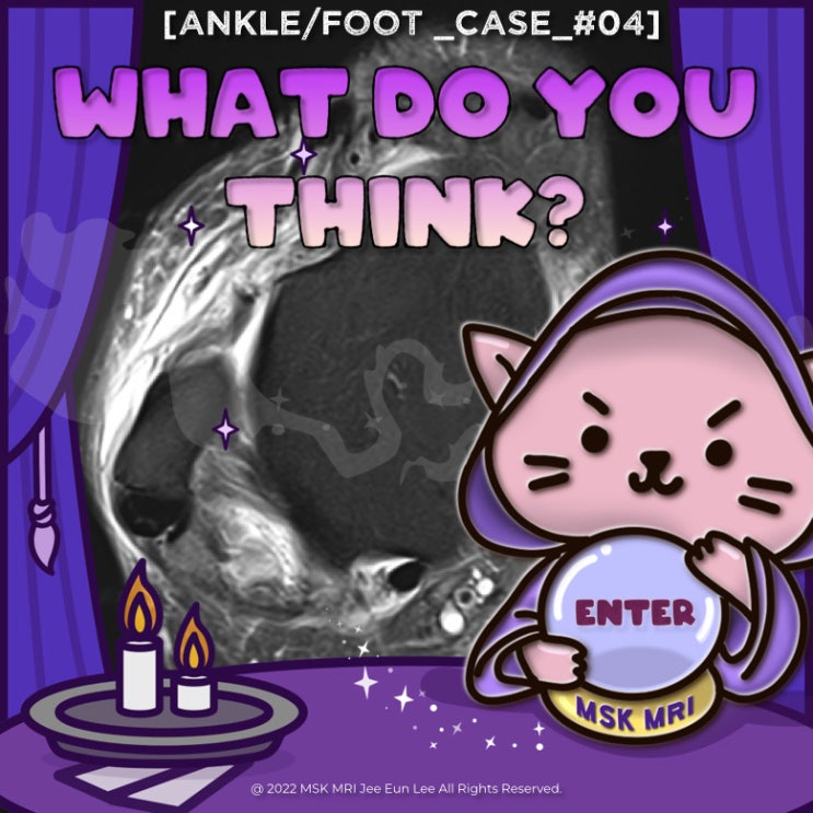 [Ankle/foot_Case_#05] [Easy level] Normal anatomy and ATFL complete ...