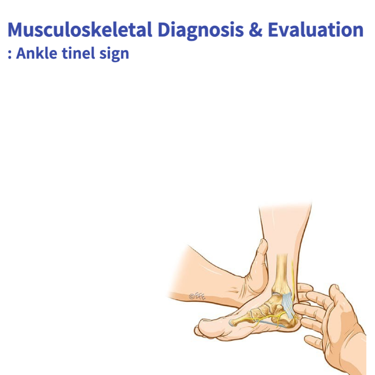 Ankle tinel sign : 발목 티넬 징후 - 말초신경 압박평가 : 네이버 블로그