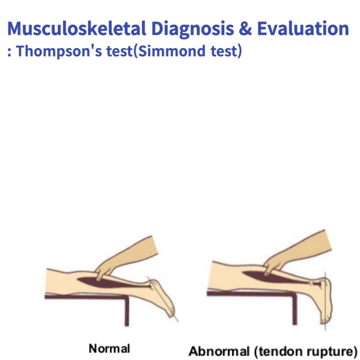 Thompson test(Simmond test) : 톰슨 검사 - 아킬레스 힘줄 파열 평가 : 네이버 블로그