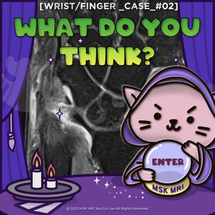 [Wrist/Finger_Case_#03] Palmer classification IB3. Complete avulsion ...