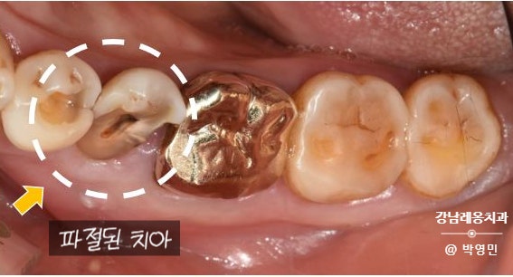 치아가 깨졌어요 잘 때 이를 갈아요 이갈이 치료 신경치료 네이버 블로그