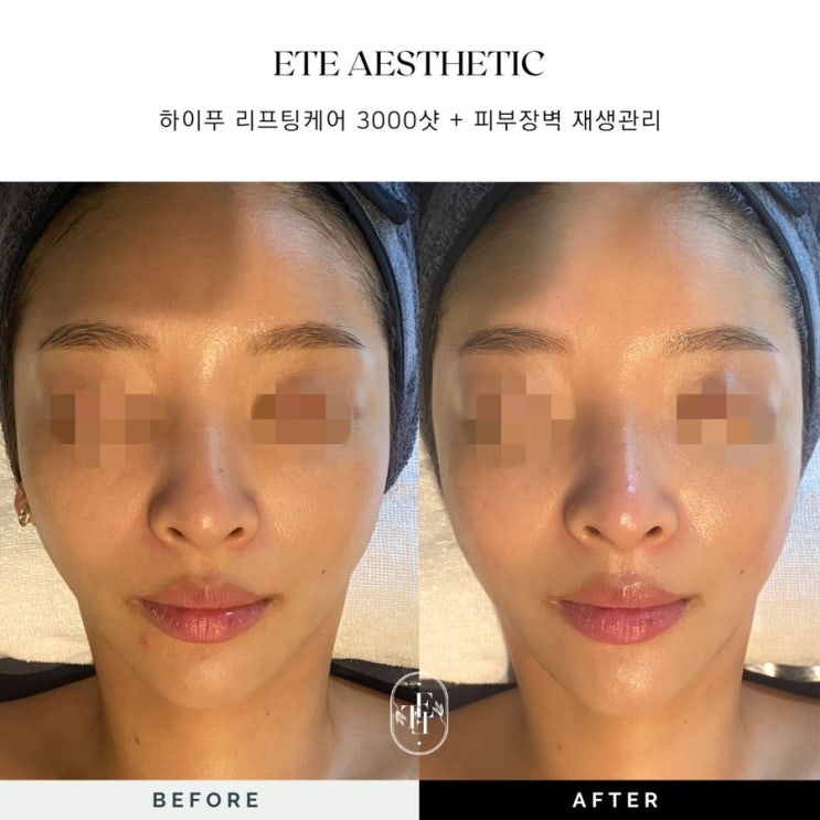 강남구청역 피부관리 하이푸리프팅관리 에떼 에스테틱 네이버 블로그