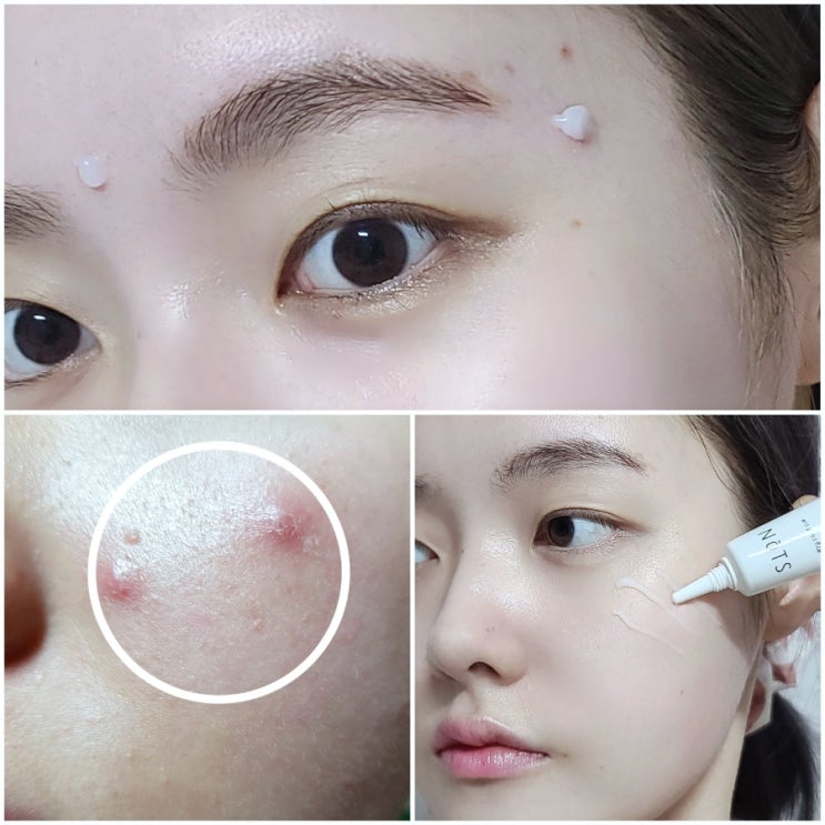 화농성 여드름 원인 연고로 관리 하기 F 낫츠 센텔라스카 연고로 미간 볼 뾰루지 없애는법 네이버 블로그