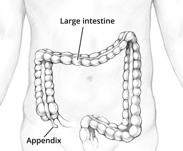 GS appendictis open/lapparoscopy : 네이버 블로그