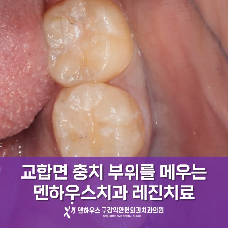 덴하우스치과 교합면 충치 부위를 메우는 덴하우스치과 레진치료 네이버 블로그