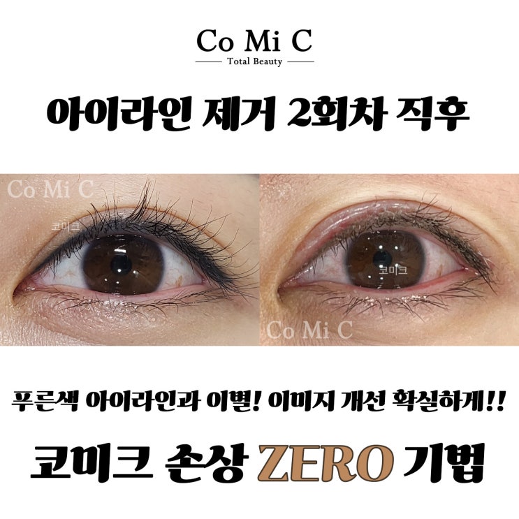 남양주 구리 눈썹문신제거 아이라인문신제거 깔끔하게 잘지우는 코미크 네이버 블로그