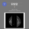 부산 유방 외과 전문의 박근준유외과의원 92 양측 유방의 크기 차이 소엽상피내암 또는 유방암 의심 네이버 블로그