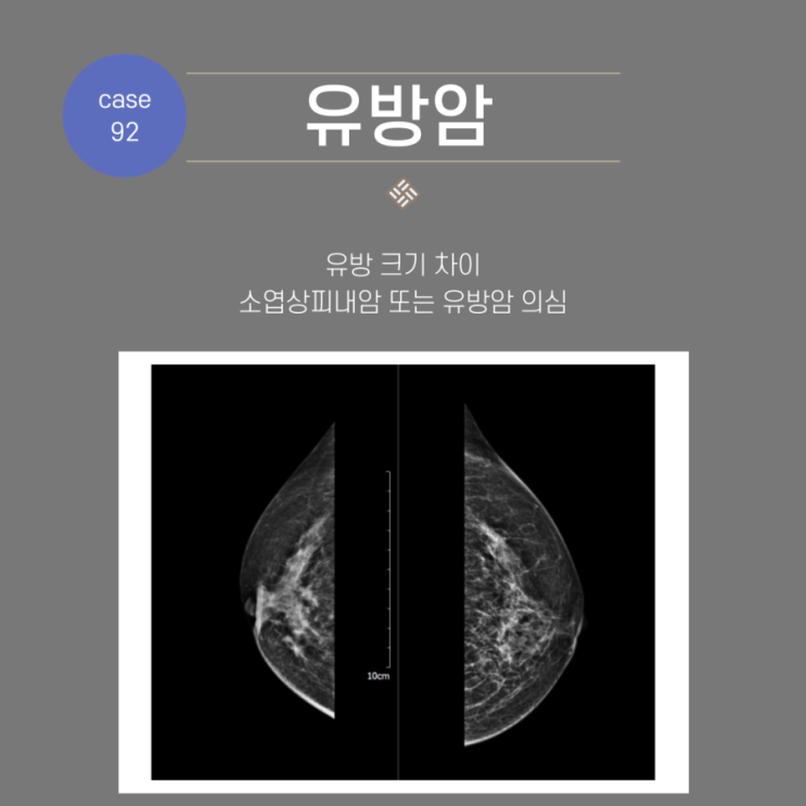 부산 유방 외과 전문의 박근준유외과의원 92 양측 유방의 크기 차이 소엽상피내암 또는 유방암 의심 네이버 블로그