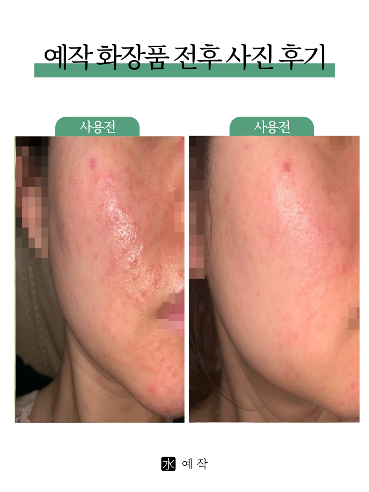 예작화장품 후기 예민한 민감성 여드름 피부 개선 네이버 블로그