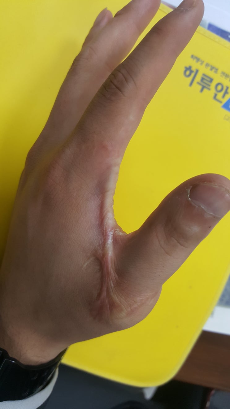 [나래병원, 손] 엄지 손가락 재접합 환자의 수술 후 구축을 해결해 보자. first web scar contracture ...