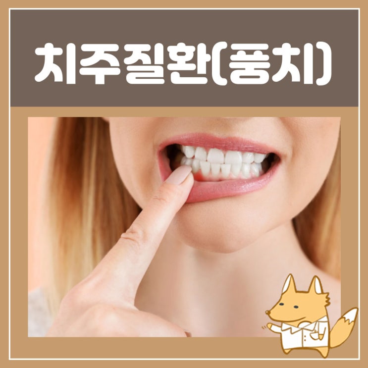 입안염증 치은염 치주염 증상 약 치주질환풍치 증상 원인 치료법 잇몸 아플때 네이버 블로그