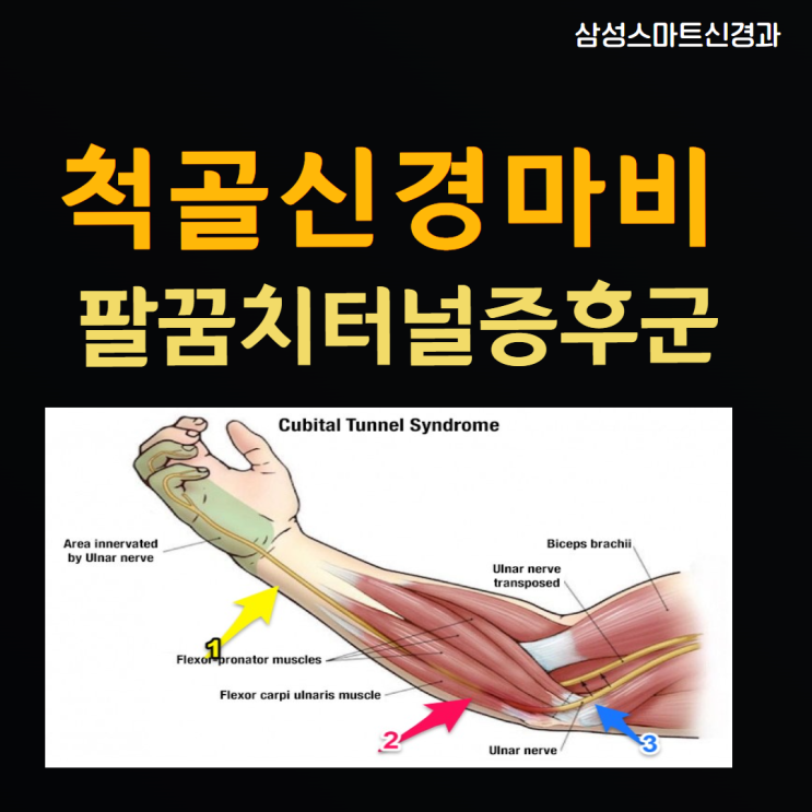 손저림 원인 팔꿈치터널증후군 척골신경마비 척골신경손상 진단은 신경전도 및 근전도 검사 네이버 블로그