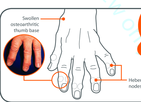 Heberden node : 헤베르덴 결절 : 네이버 블로그