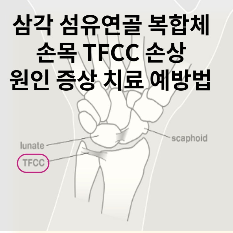손목 바깥쪽으로 반복되는 통증. TFCC(삼각섬유연골 복합체) 손상일 수 있습니다. TFCC 한방치료, TFCC 비수술 치료 ...