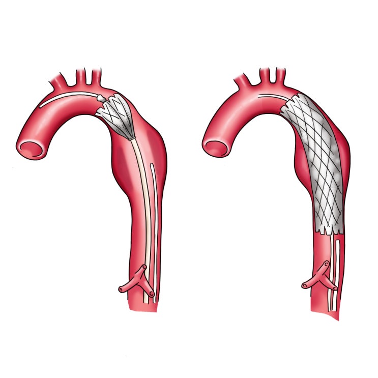 흉부 대동맥 질환의 스텐트 삽입술(Thoracic Endovascular Aneurysm Repair, TEVAR) : 네이버 블로그