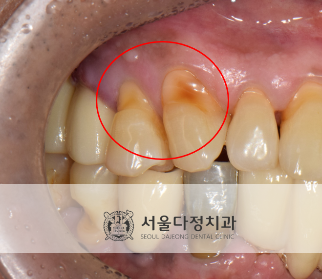 오류동치과 치경부마모 치아파임 레진으로 치료하기 네이버 블로그