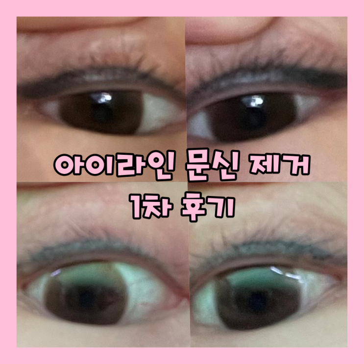 주사 마취 피코 레이저 시술 후기두줄따기 5개월 차 네이버 블로그