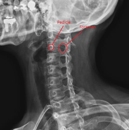 Cervical selective nerve root block (SNRB) : 네이버 블로그