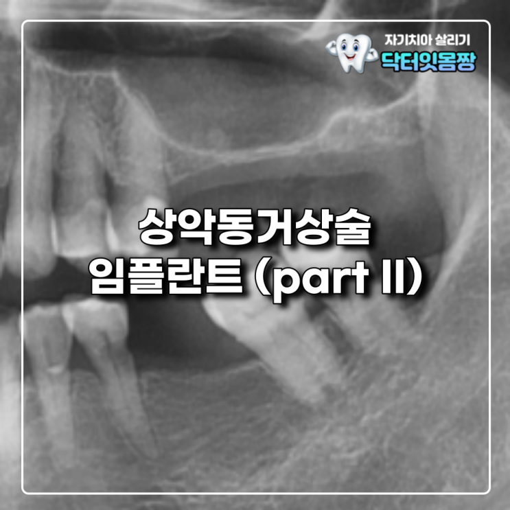 위턱뼈 임플란트 수술 상악동 거상술 뼈이식 네비게이션 임플란트 Ct로 꼼꼼하게 네이버 블로그