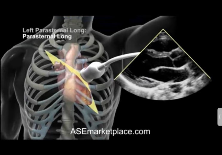 심장초음파 검사 비용 및 의학용어 TTE & TEE , TOE 공부하기 : 네이버 블로그