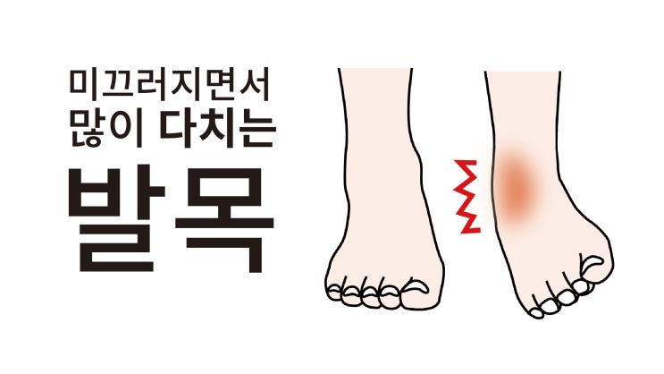 발목 삐끗 접질렸을 때 발목 염좌 응급처치방법과 치료 네이버 블로그