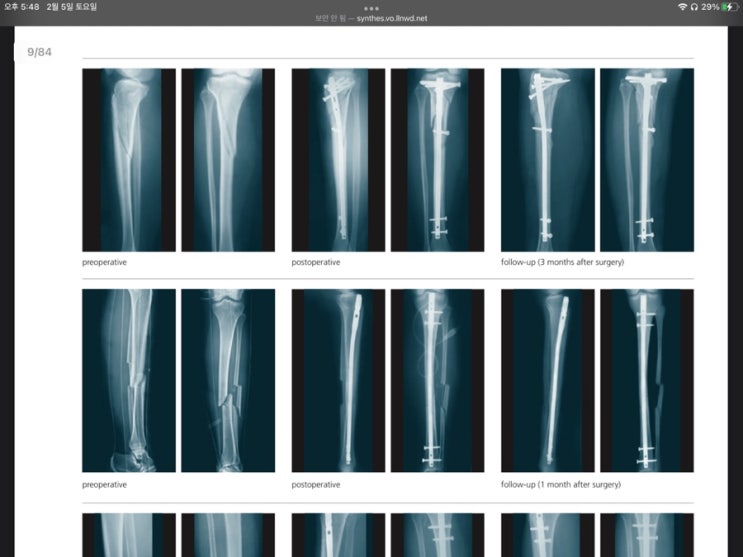[OS]Synthes Tibia IM nail(22.02.13 수정) : 네이버 블로그