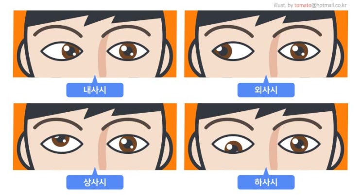 사시 사위 다른 점” 은 검안전문 안경원 마곡 안경원 발산역 안경원 비엔나 안경원 네이버 블로그