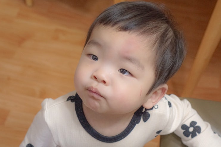 아기 머리 부딪힘 아기 뇌진탕 증상은 아기 얼굴 멍들었을때 대처법 W이마 혹 네이버 블로그