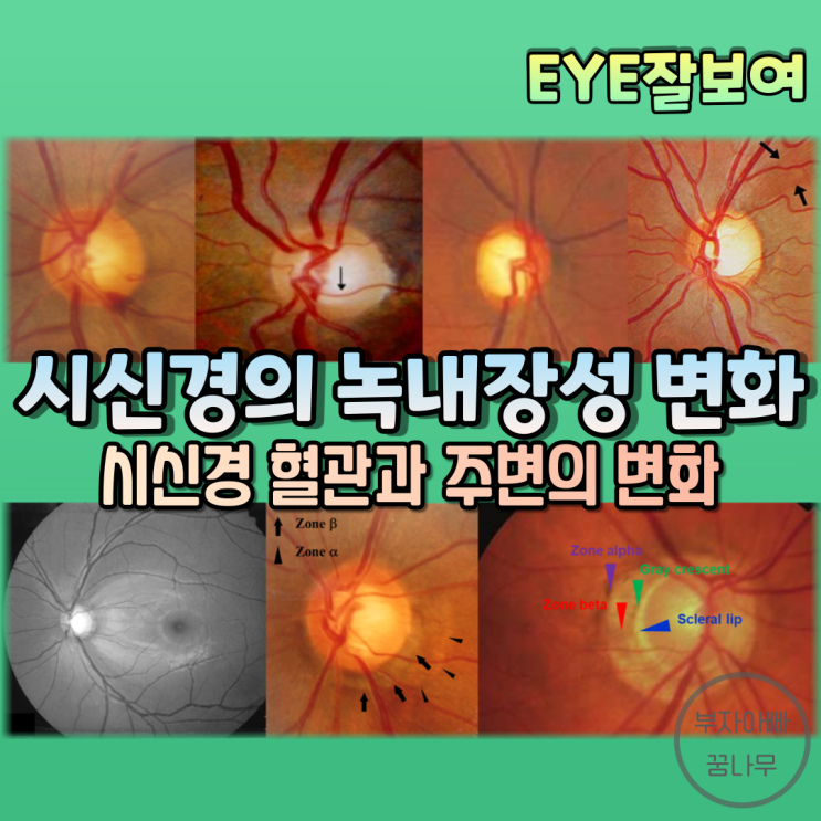 [EYE잘보여] 시신경의 녹내장성 변화 (2) - 시신경 혈관과 주변의 변화: VASCULAR SIGN ...
