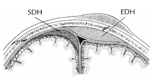 EDH & SDH&IVH&SAH&ICH : 네이버 블로그