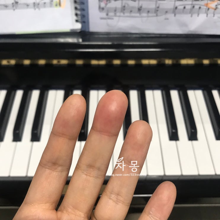 생인손조갑주위염 병원 치료 생전 처음 걸려본 사람 네이버 블로그
