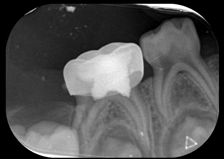 [치과의사용 further study] 유치 MTA 치수절단술(MTA pulpotomy) 술식과정 : 네이버 블로그