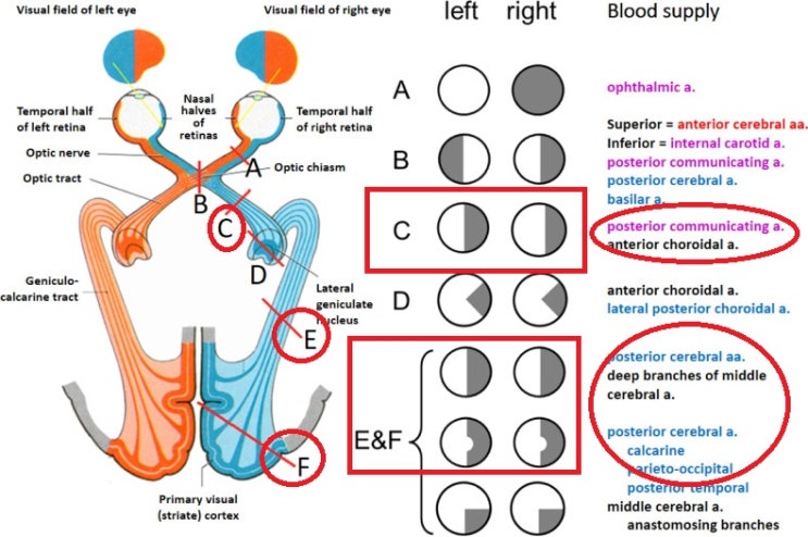 눈 반쪽이 안보인다? contralateral homonymous hemianopia, 반맹증; 후두엽 뇌경색 응급평가 필요 ...