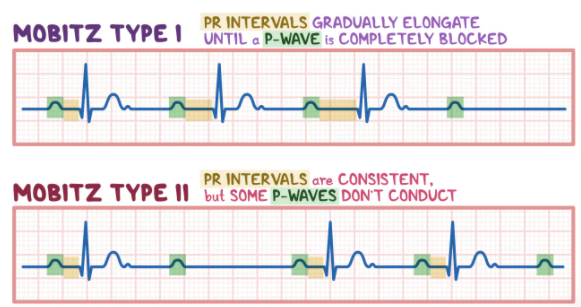 [EKG의 모든 것-2] 서맥의 종류와 치료방법 : 네이버 블로그