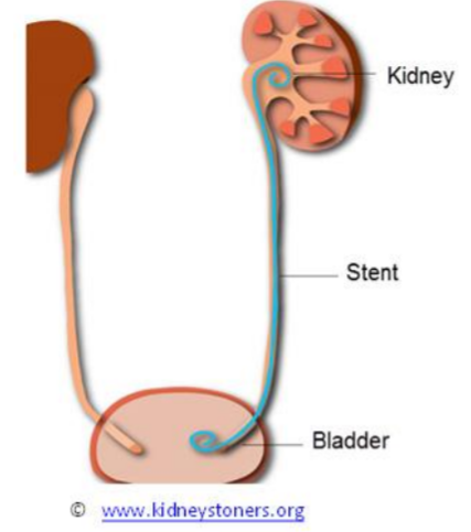 DJ stent (Double J stent) 요관부목설치술 : 네이버 블로그