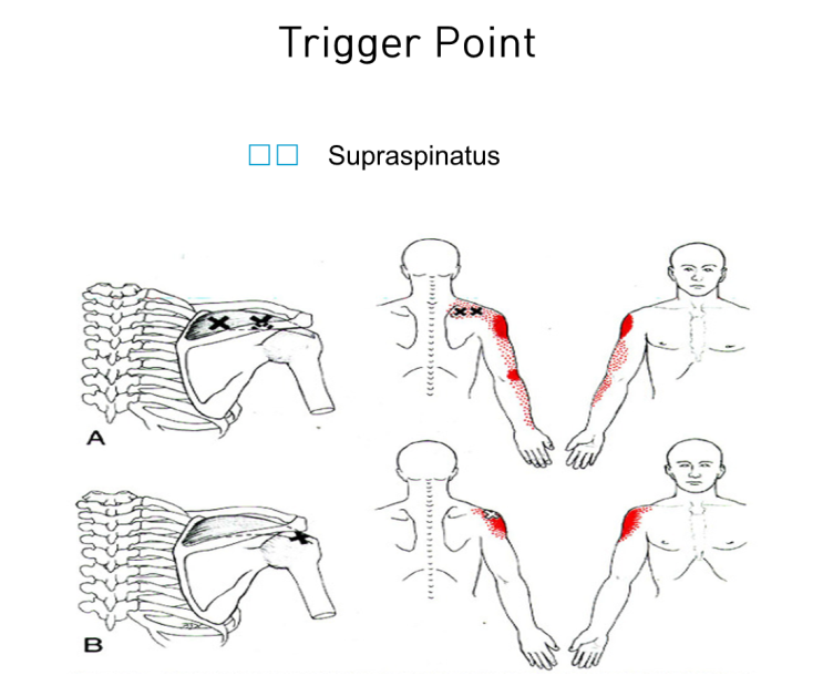 어깨 뭉침! 통증! 회전근개 증상과 트리거 포인트를 알아보자. (Trigger Point) Part.2 : 네이버 블로그