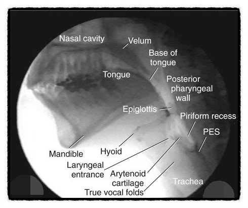 비디오 투시 삼킴검사 Videofluoroscopic swallowing study; VFSS : 네이버 블로그