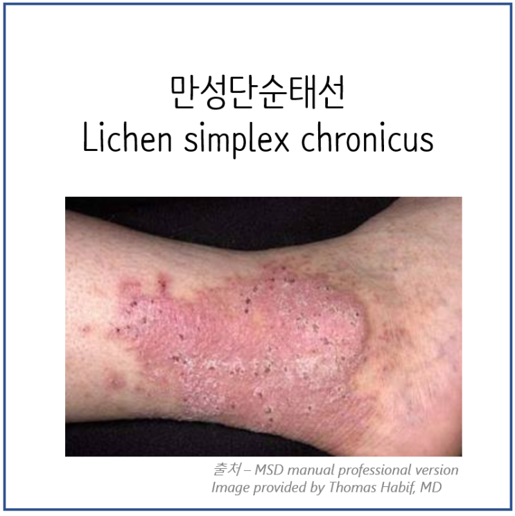 가려워서 긁었더니 피부가 점점 두꺼워지고 각질이 생겨요 - 만성단순태선(Lichen simplex chronicus) : 네이버 블로그