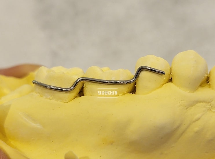 치아정출방지 레진와이어스플린트 wire splint, 누구냐 넌. : 네이버 블로그