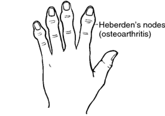헤버딘 결절 Heberden's node : 네이버 블로그