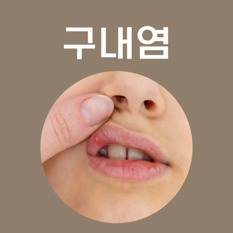 구내염 빨리 낫는법 입술 헤르페스 원인 증상 약 혀백태 칸디다 칸디다증 입안 헐었을때 물집 수포 아프타성 네이버 블로그