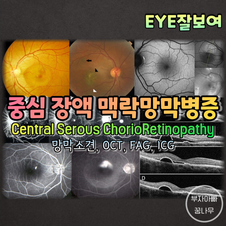 [EYE잘보여] 중심 장액 맥락망막병증(Central Serous ChorioRetinopathy; CSCR, CSC) (2 ...