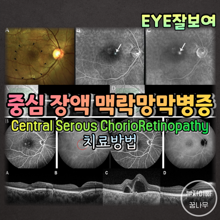[EYE잘보여] 중심 장액 맥락망막병증(Central Serous ChorioRetinopathy; CSCR, CSC) (3 ...