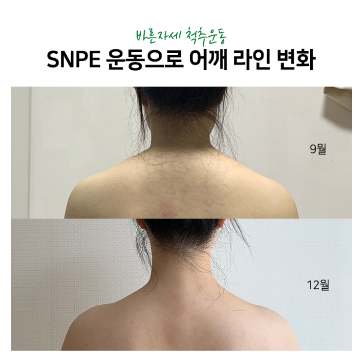SNPE 운동으로 어깨라인 변화 : 네이버 블로그