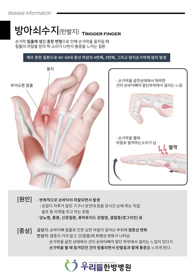 순천 방아쇠수지 손가락을 펼 때 딱 소리가 나면서 통증을 느끼게 되는 손가락 힘줄의 윤활막염에 대하여 알아봅시다 네이버 블로그
