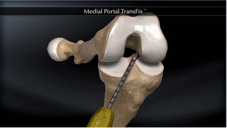 ACL Medial Portal : TransFix : 네이버 블로그