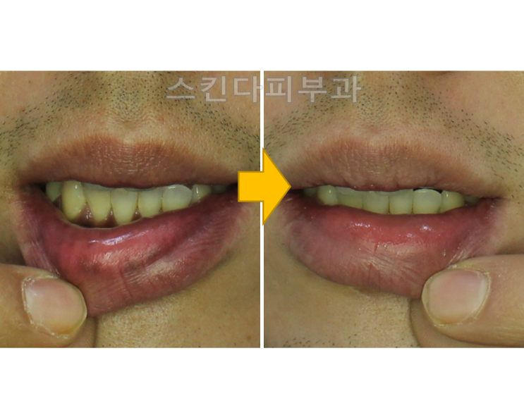 입술색소침착 입가색소침착 검은입술 레이저치료 많은사례후기feat레이저토닝 네이버 블로그