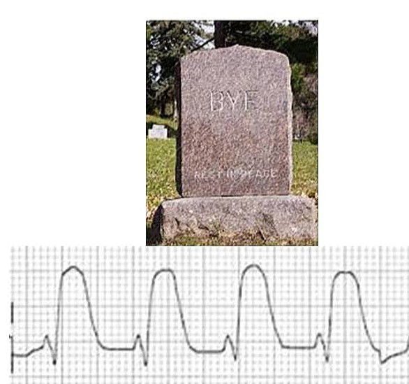 묘석 심전도 tombstone ECG? : 네이버 블로그