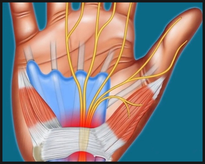 수근관증후군 / 손목터널증후군(Carpal tunnel syndrome, CTS) : 팔렌 검사, 수정된 팔렌 검사, 역팔렌 ...